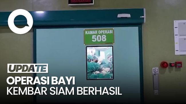 Bayi Kembar Siam Sukses Dipisahkan di RSSA Malang