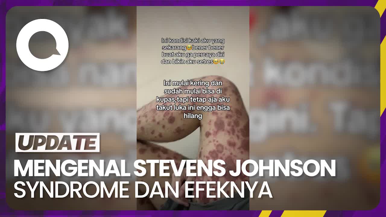 Stevens Johnson Syndrome, Penyakit Kulit yang Tergolong Berbahaya