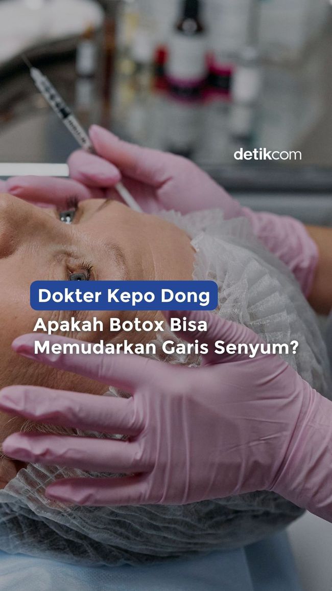 Botox Bisa Atasi Garis Senyum?